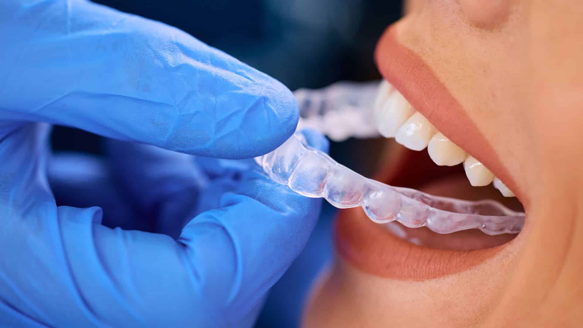 Invisalign - Cost & Benefits Of The Treatment