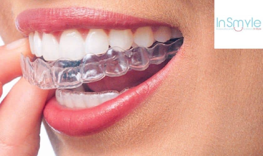 Invisalign - Cost & Benefits Of The Treatment