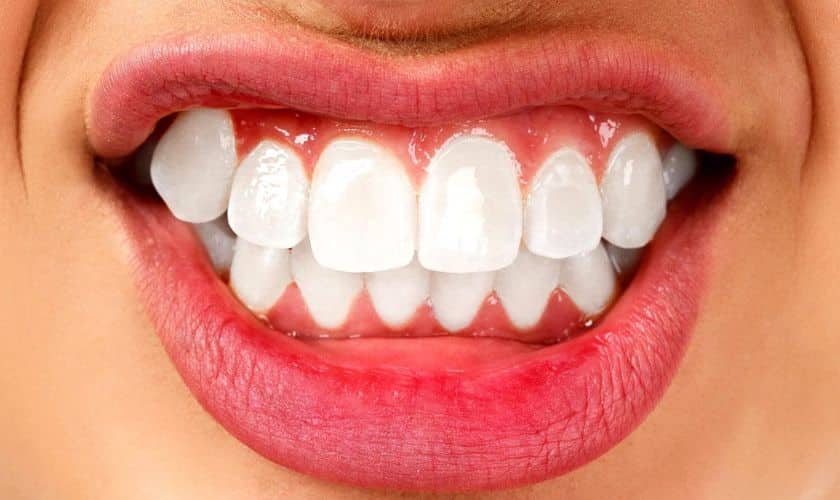 How to treat bruxism- Symptoms, Causes, and Treatment