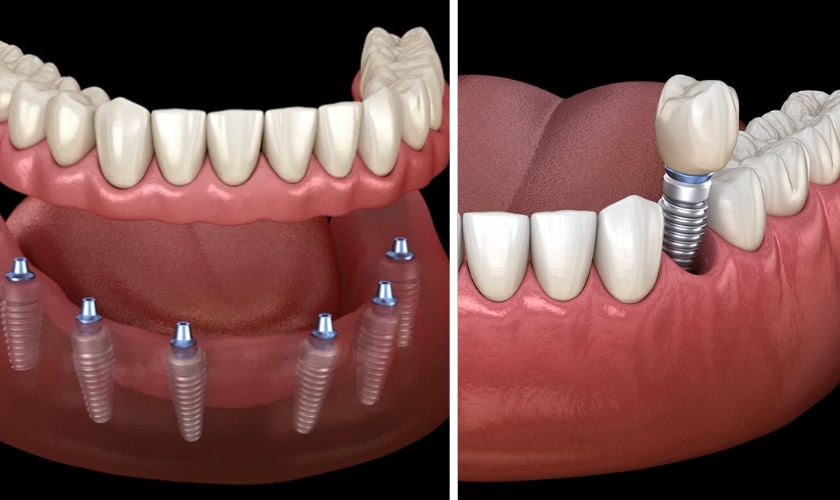 Single Tooth or Multiple Tooth Replacement? Which is Better?