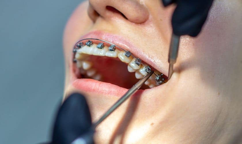 Brackets Dentales De Acero Inoxidable