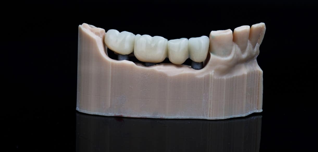 Caring for Your Dental Bridge: Easy Daily Tips